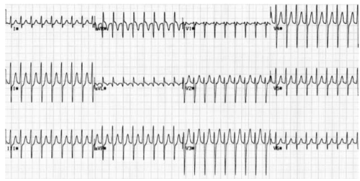 Narrow Complex Tachycardias – The Lay Medical Man