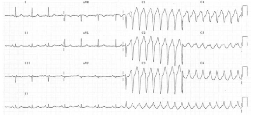 Narrow Complex Tachycardias – The Lay Medical Man